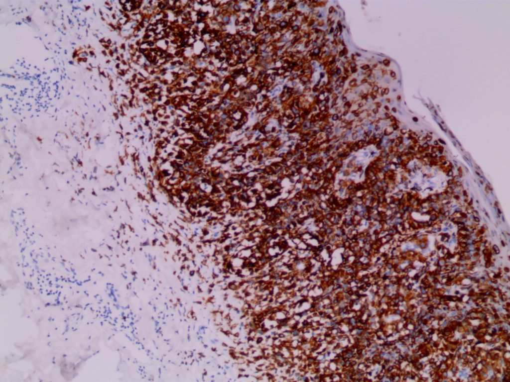 Melanoma (HMB45) - labex